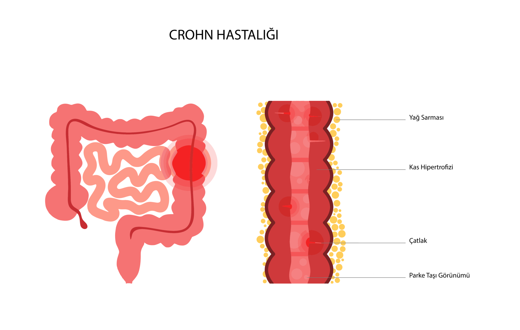 Crohn Hastalığı