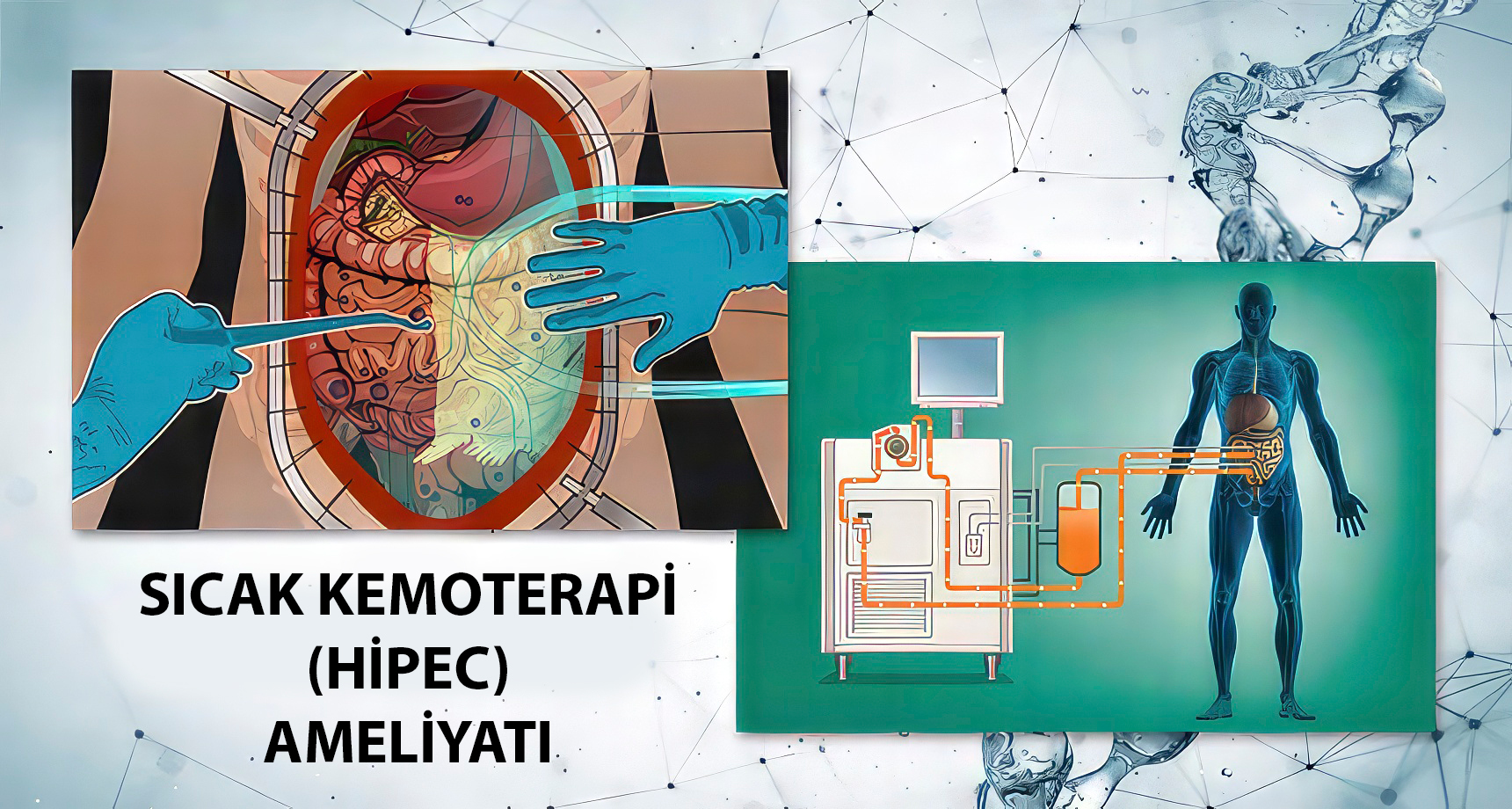 Sıcak Kemoterapi (HİPEC) Nedir? Nasıl Uygulanır?