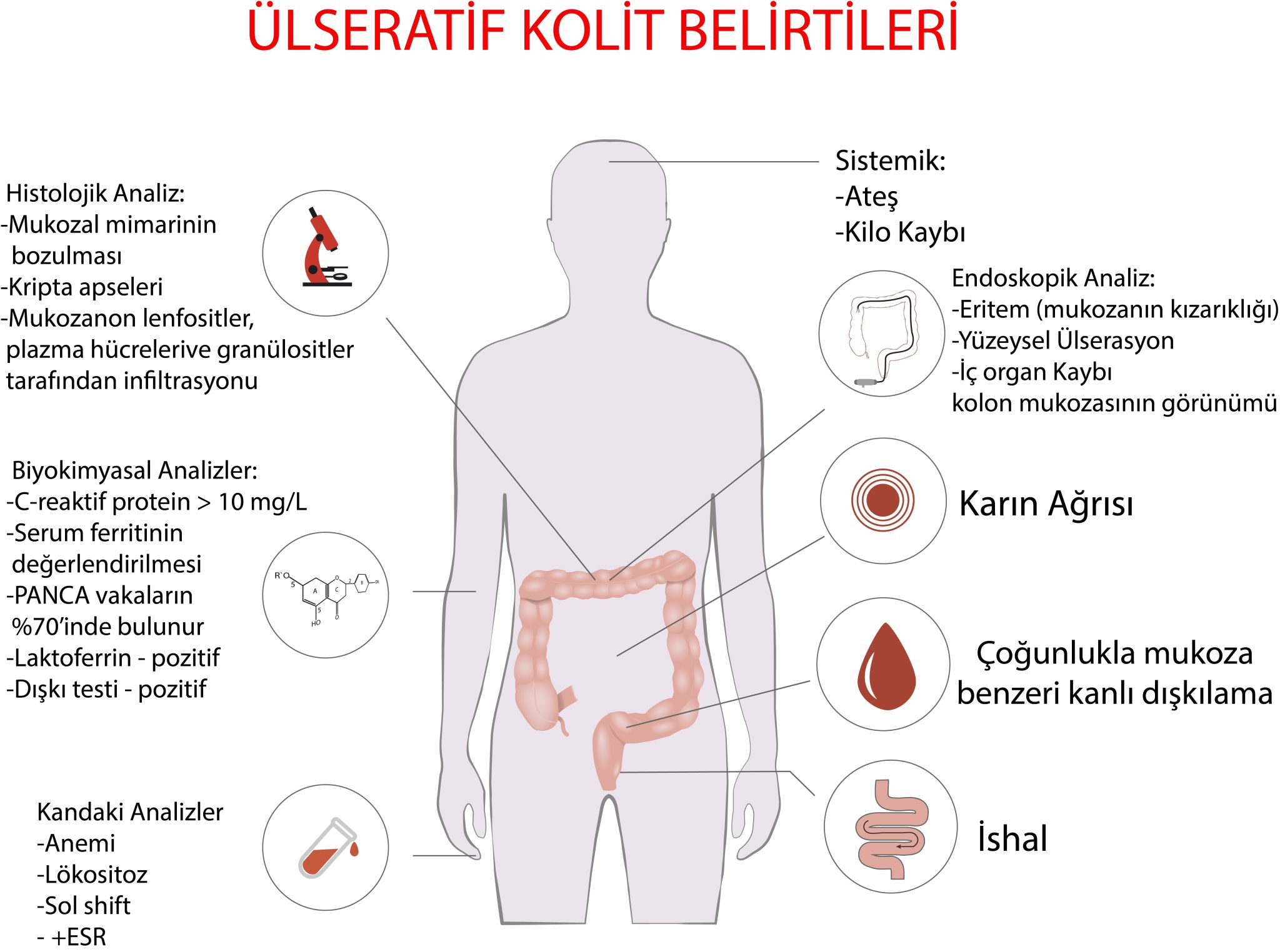 Ülseratif Kolit